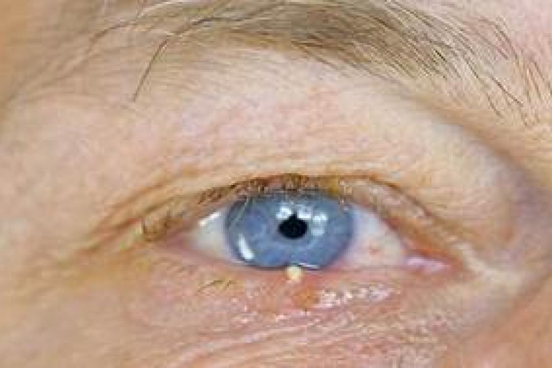 ¿Por qué salen los orzuelos y qué puedo hacer para curarlos?