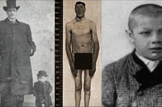 El curioso caso de Adam Rainer, el único humano en padecer enanismo y ...