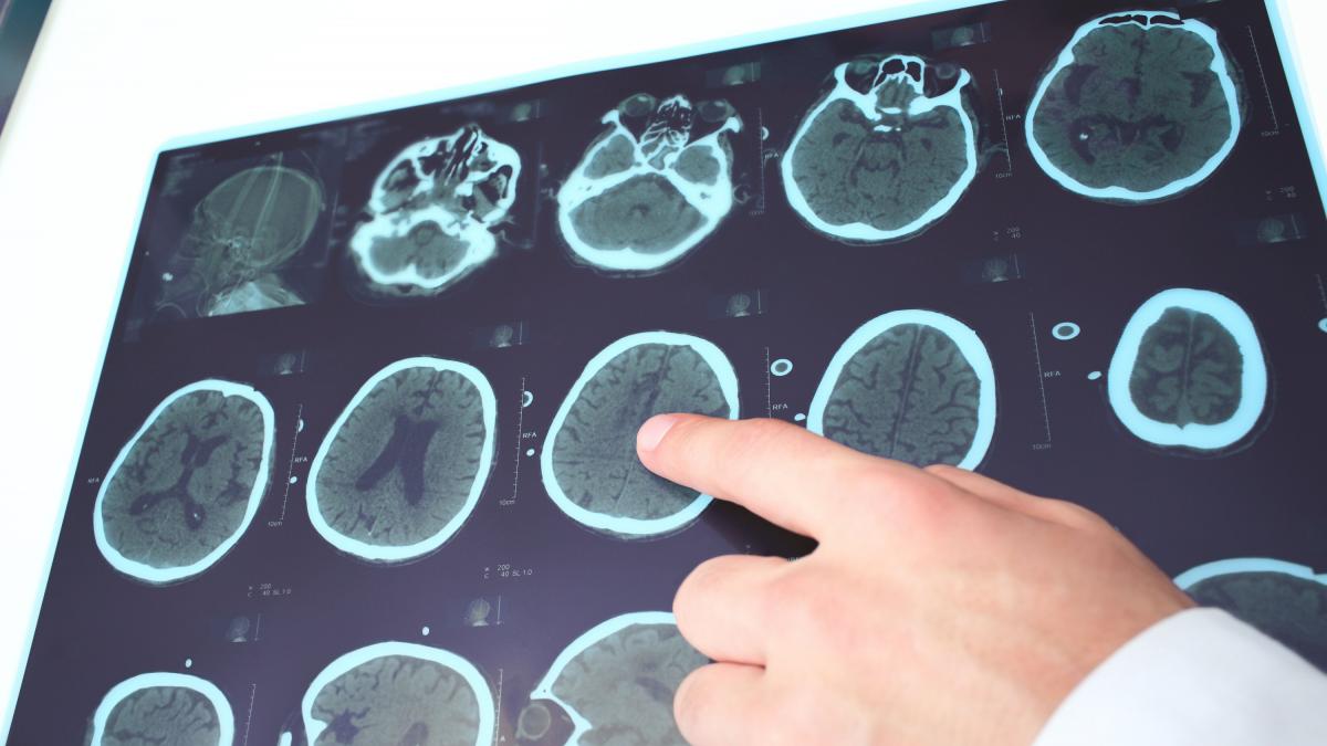 Un algoritmo recomienda el mejor tratamiento para la esclerosis múltiple