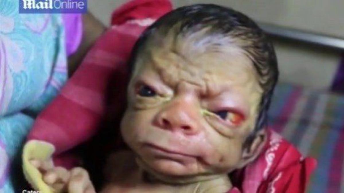 Nace en Bangladesh un bebé con la enfermedad de 'Benjamin Button'