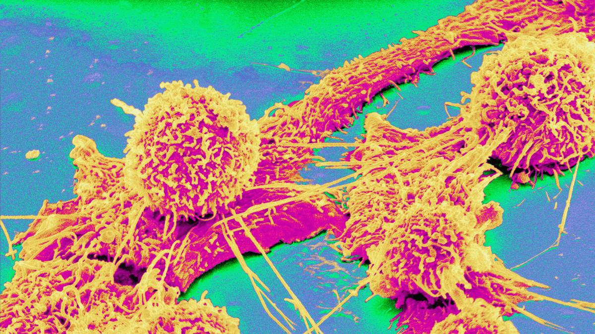 La medicina está muy cerca del motivo de la explosión del cáncer de ...